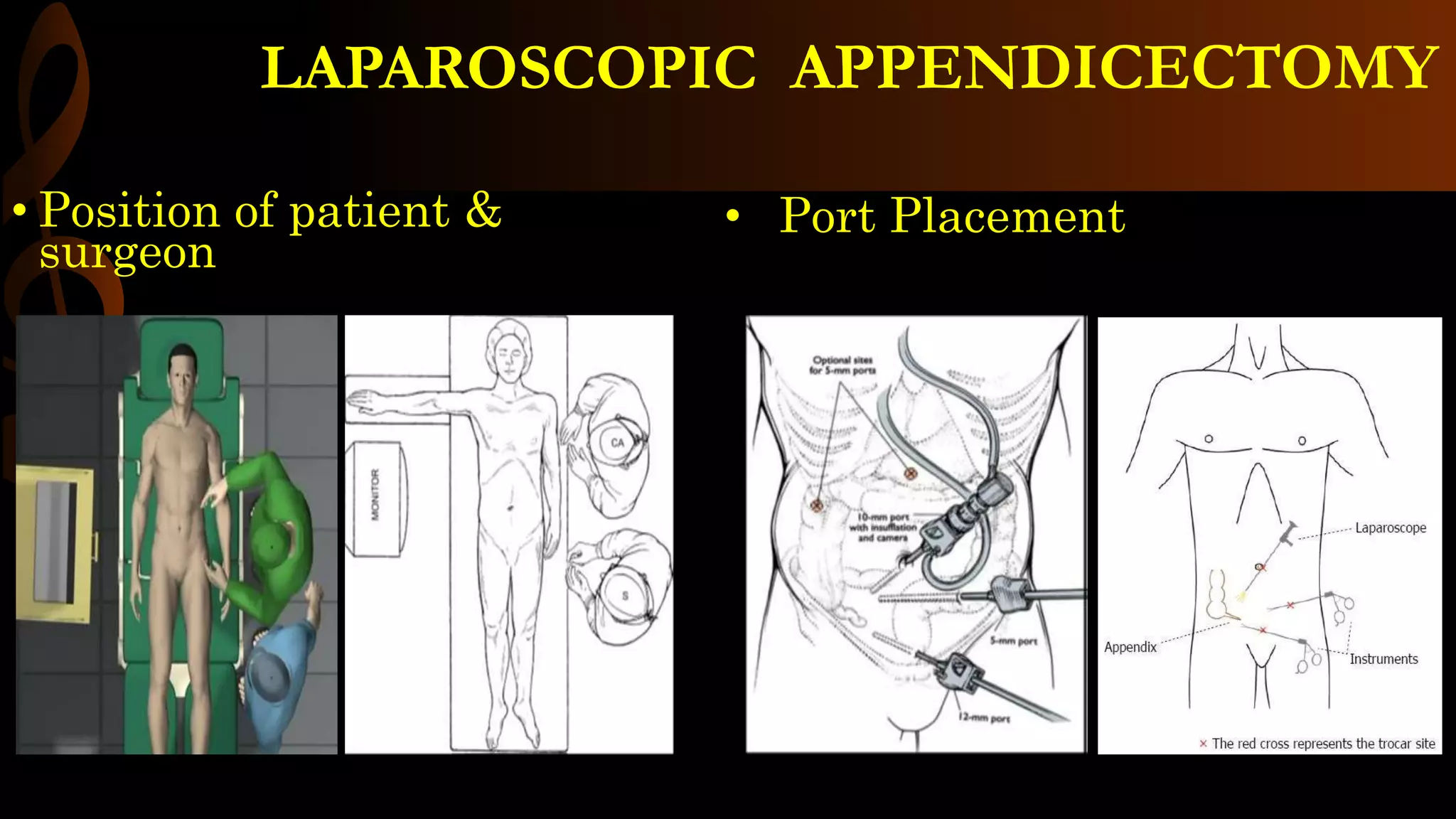 Laparoscopic Appendicectomy- Operative Surgery | PPTX