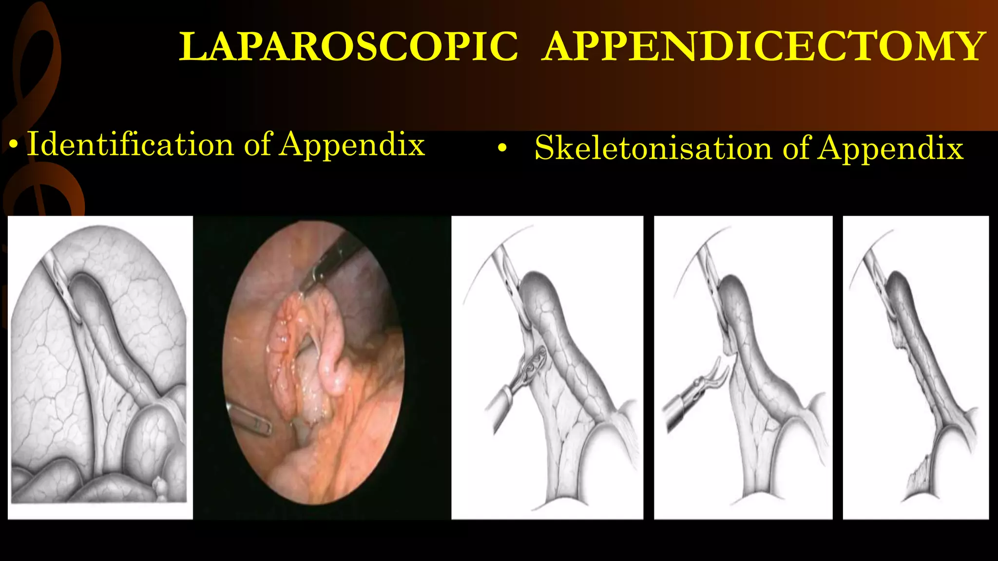 Laparoscopic Appendicectomy- Operative Surgery | PPTX