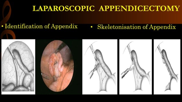 Laparoscopic Appendicectomy- Operative Surgery