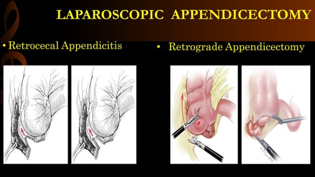 Laparoscopic Appendicectomy- Operative Surgery