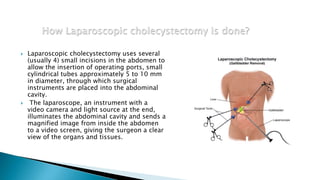 Laparoscopic cholecystectomy | PPTX