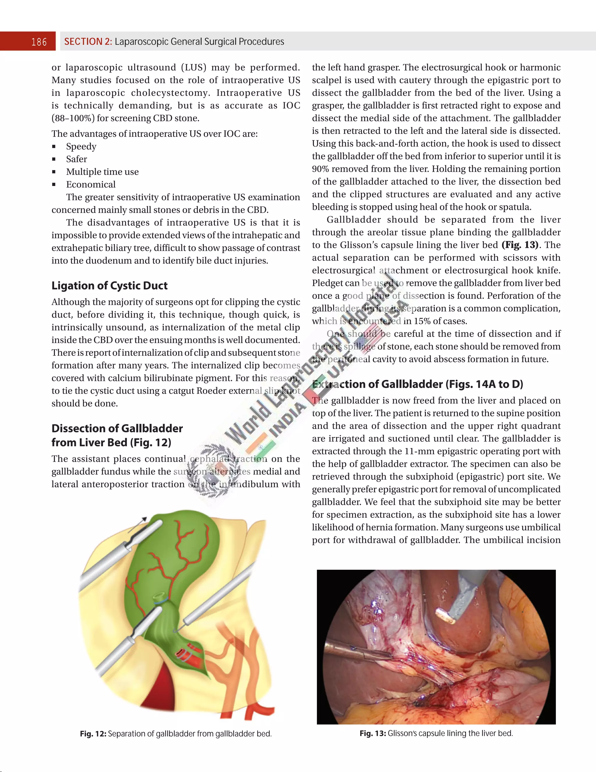 Laparoscopic Cholecystectomy | PDF