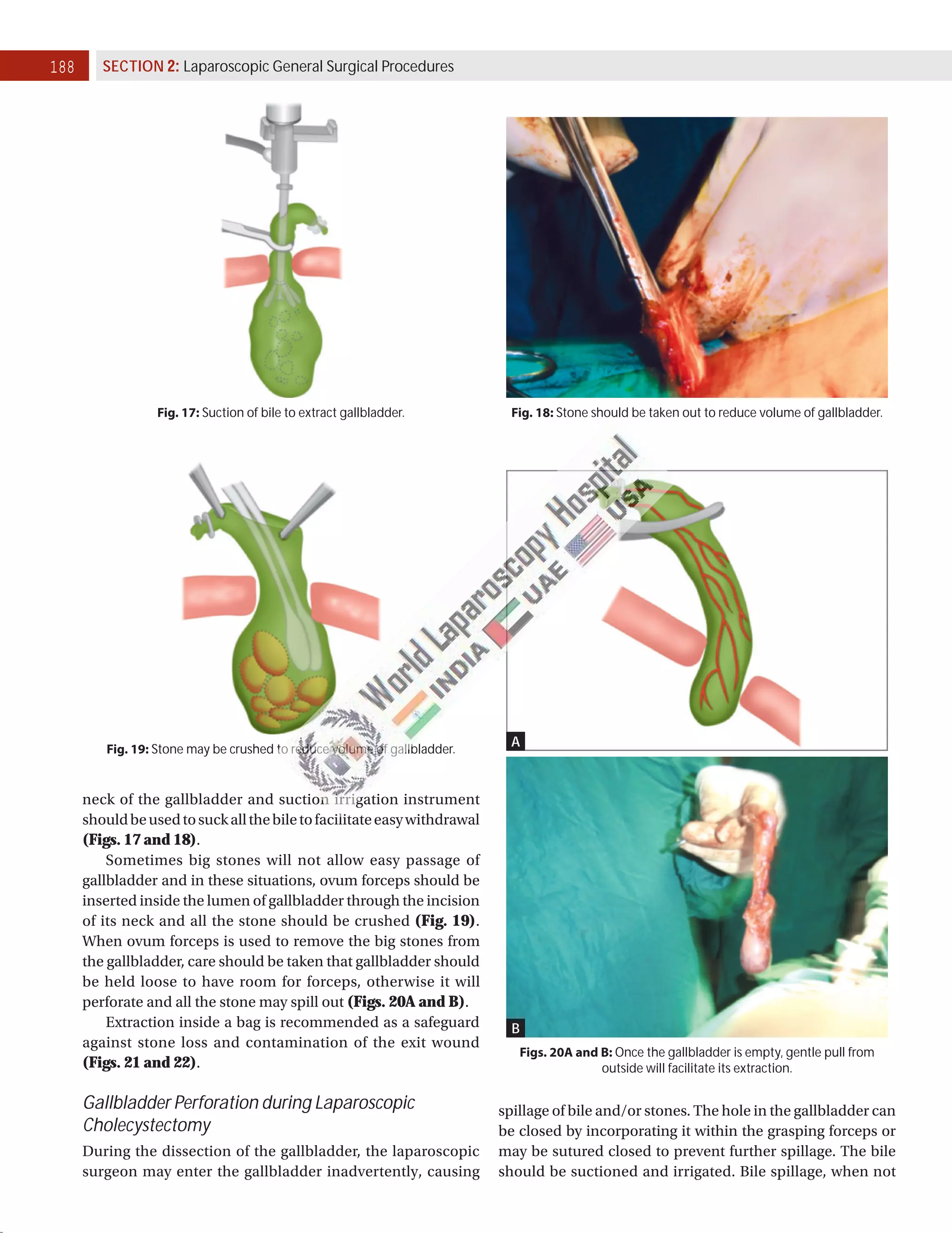 Laparoscopic Cholecystectomy | PDF