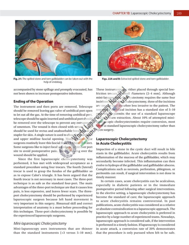 Laparoscopic Cholecystectomy | PDF