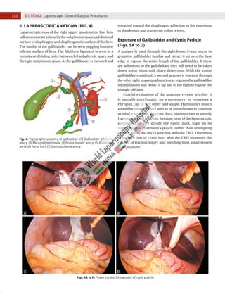 Laparoscopic Cholecystectomy | PDF