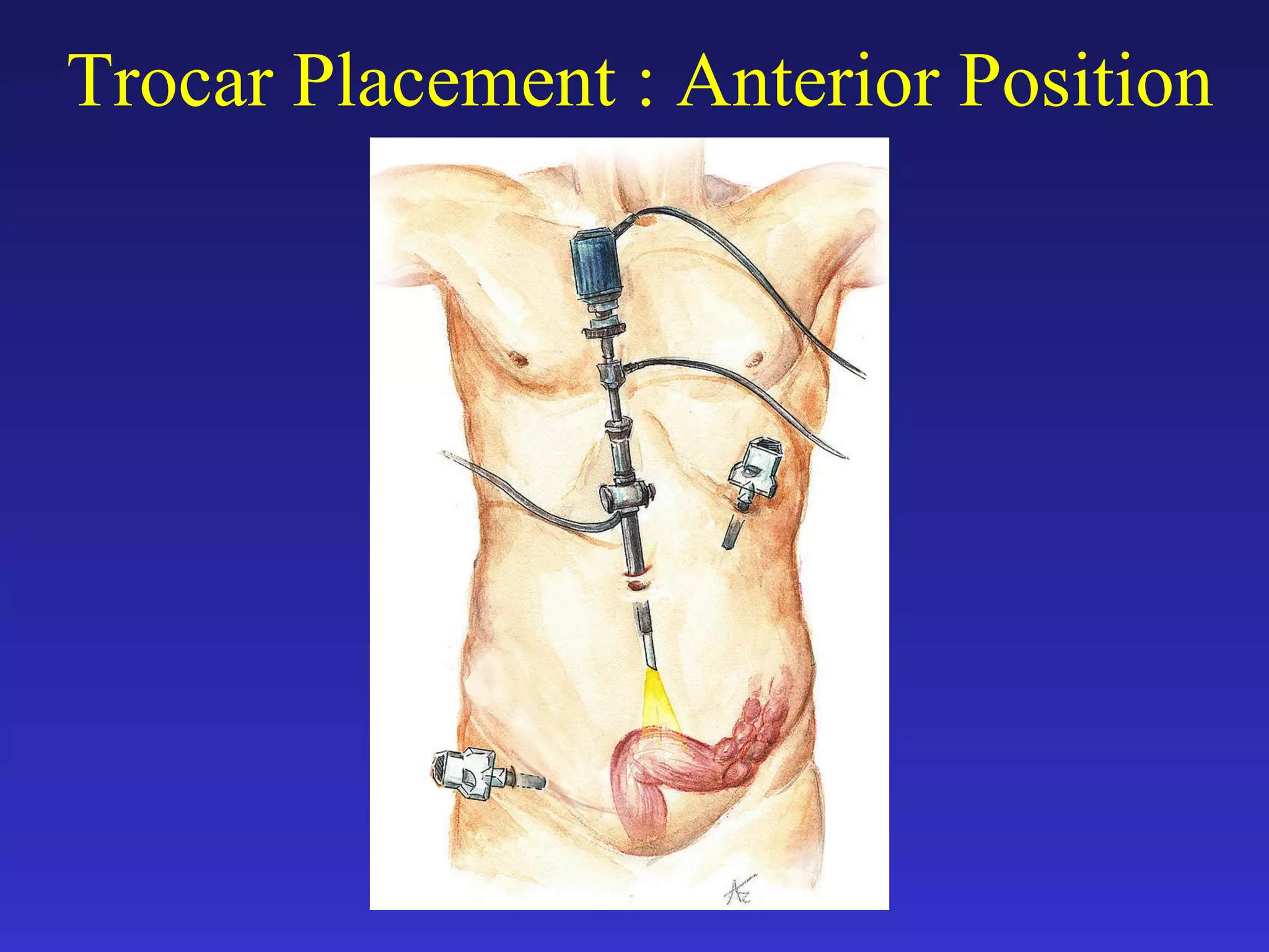 Laparoscopic Colon Resection - Anterior Approach | PPT