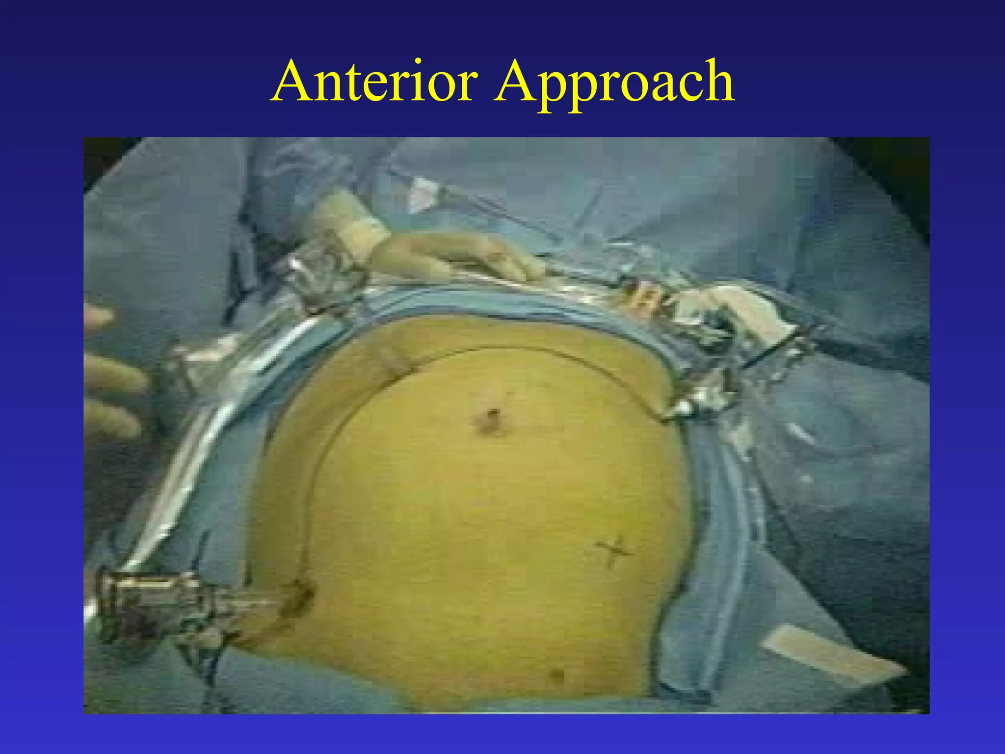 Laparoscopic Colon Resection - Anterior Approach | PPT