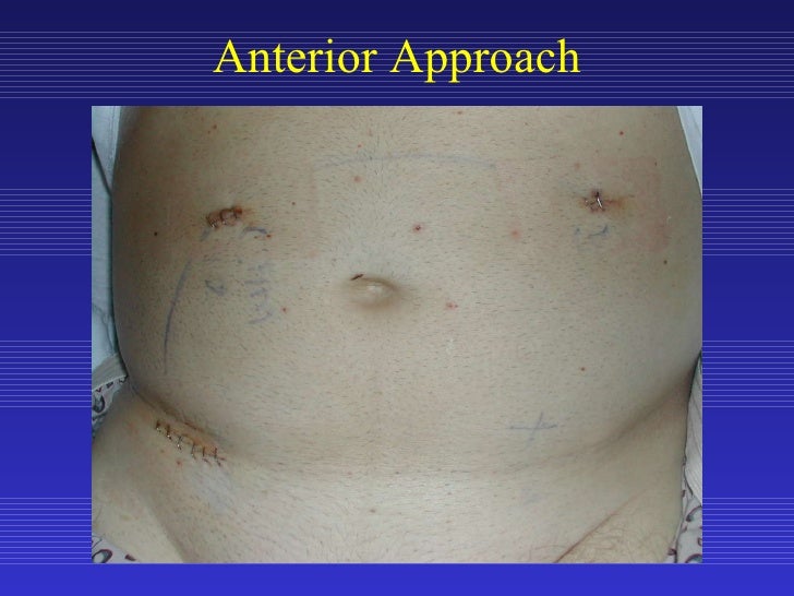 Laparoscopic Colon Resection Anterior Approach Laparoscopic Colon Resection Anterior Approach