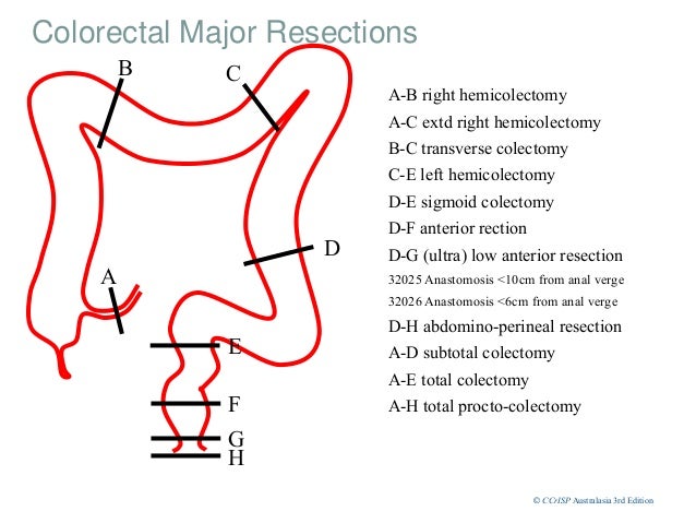 Η Λαπαροσκοπική Χειρουργική στον Καρκίνο του Παχέος Εντέρου και του Ο…