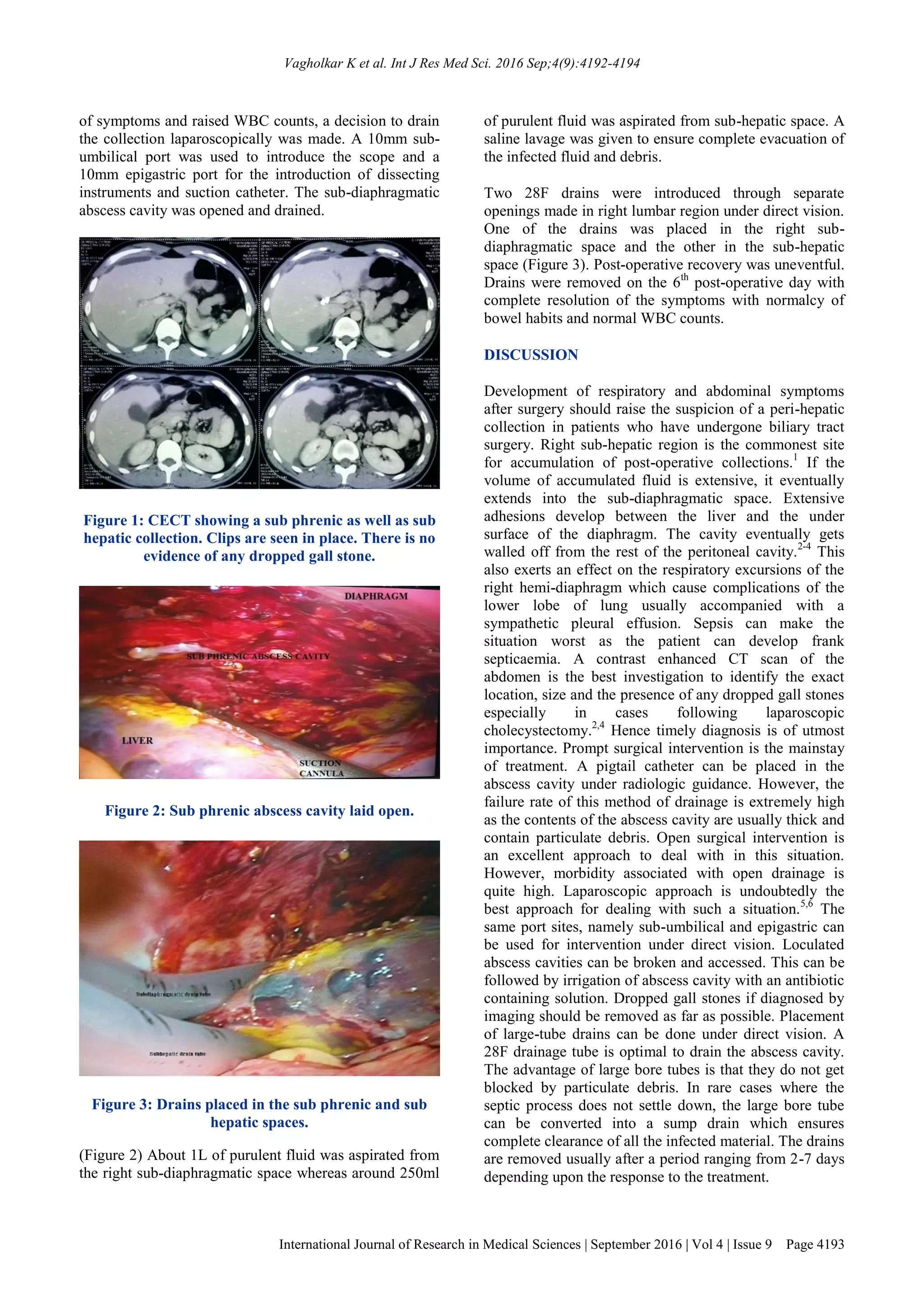 Laparoscopic drainage of subphrenic abscess | PDF