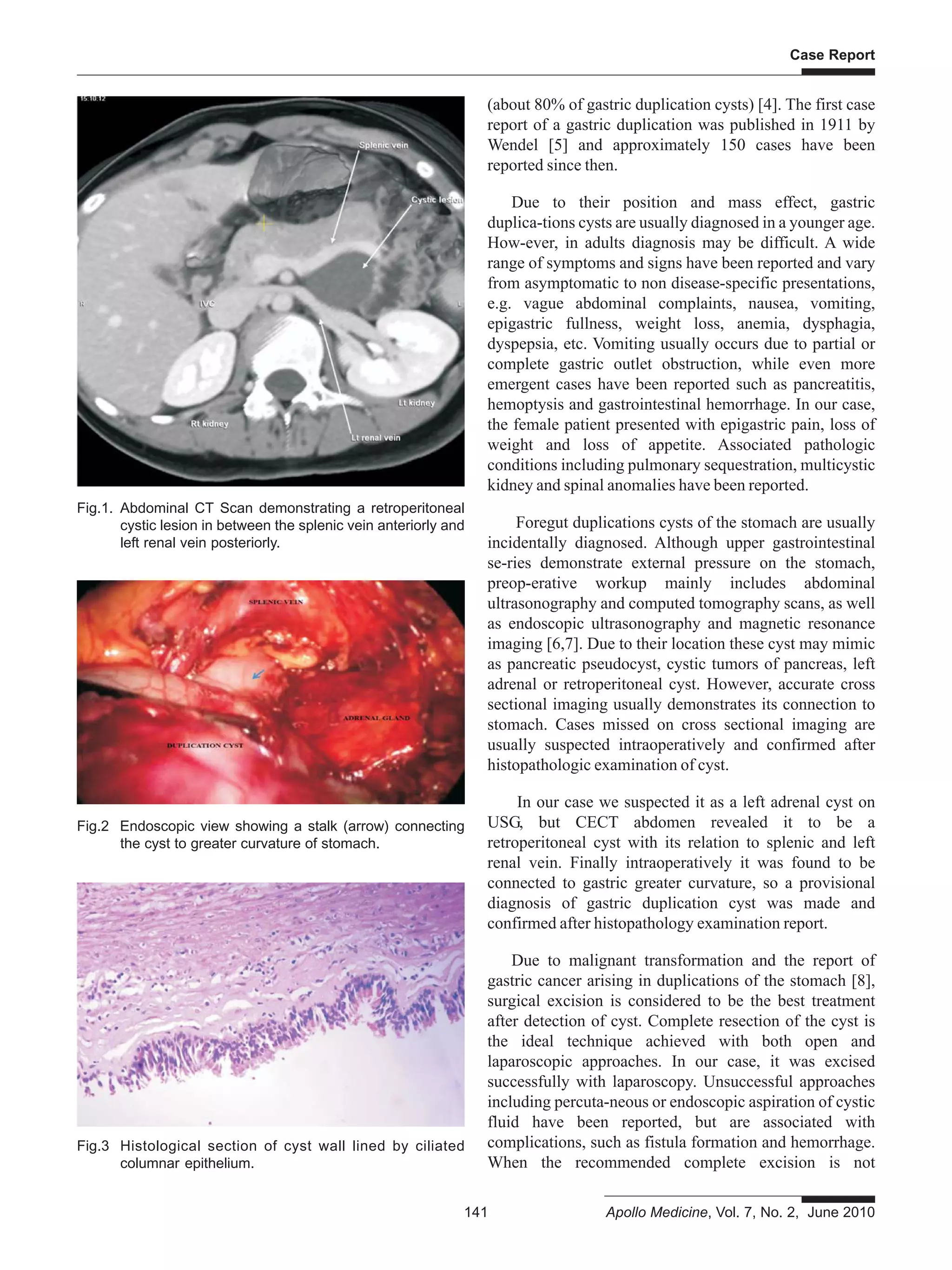 Laparoscopic Excision Of Foregut Duplication Cyst Of Stomach Pdf