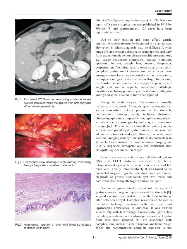 Laparoscopic Excision Of Foregut Duplication Cyst Of Stomach