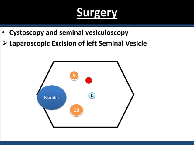 Laparoscopic excision of left seminal vesicle | PPT