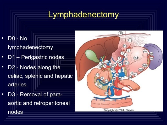 Laparoscopic gastrectomies for cancer
