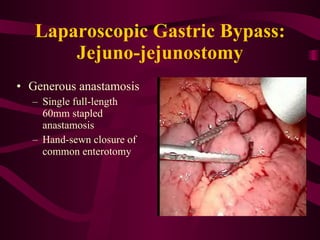 Laparoscopic Gastric Bypass: Addressing Potential Complications | PPT