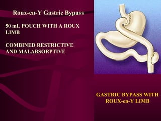 Laparoscopic Gastric Bypass: Addressing Potential Complications | PPT
