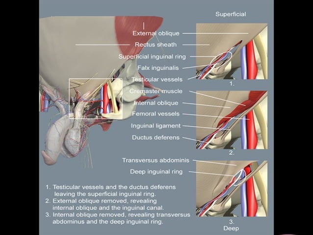 Laparoscopic groin hernia repair anatomy & technique | PPT