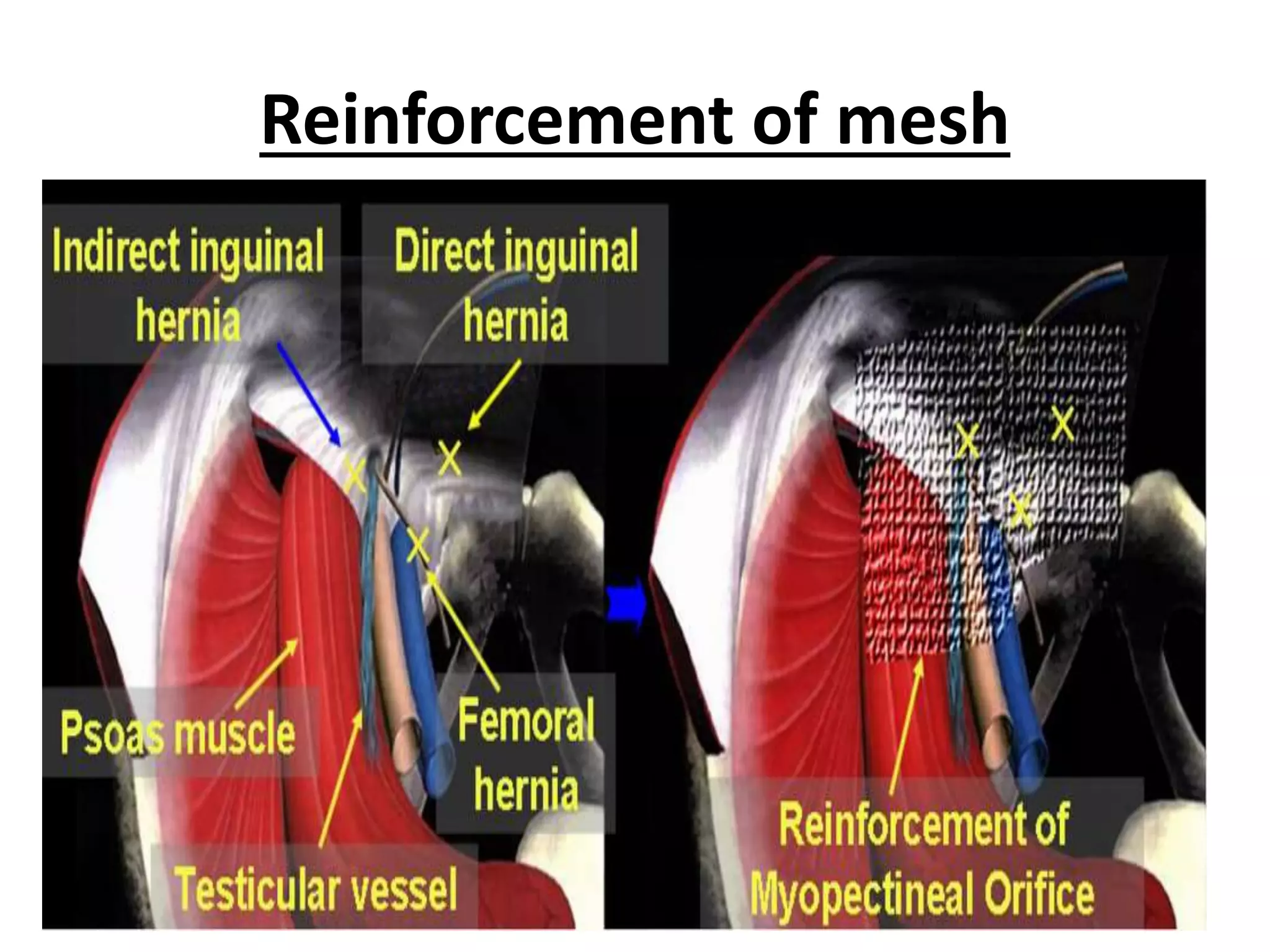 Myopectineal Orifice