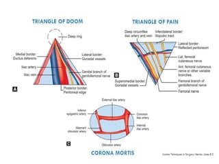 Laparoscopic Inguinal Hernia Repair Triangle Of Doom