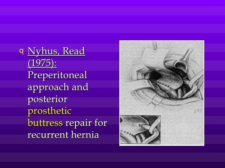 Laparoscopic Herniorrhaphy: TEP