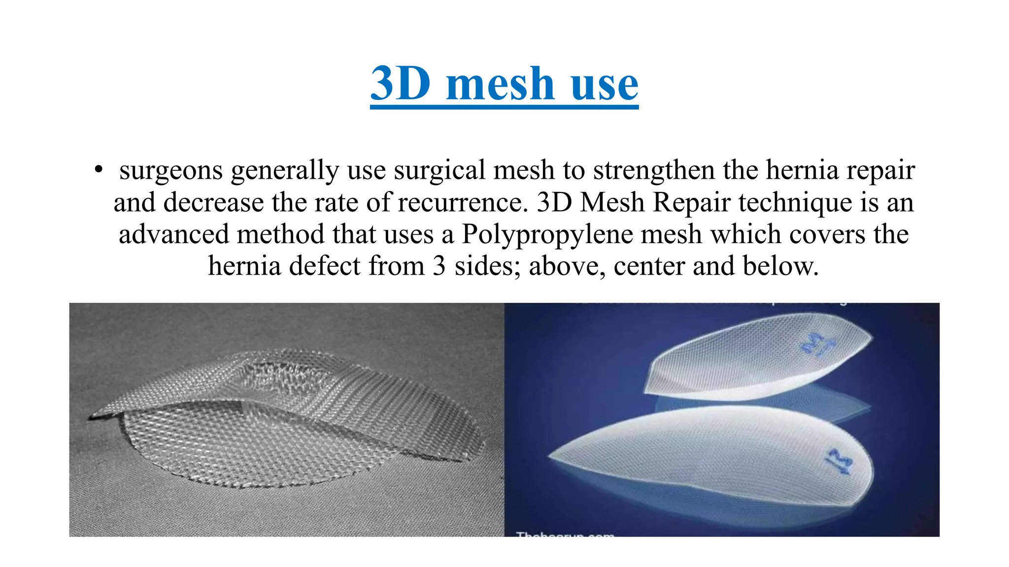Laparoscopic inguinal hernia prep | PPTX
