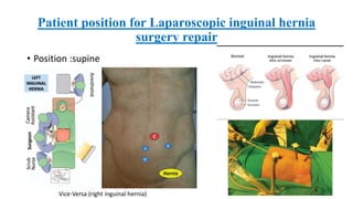 Laparoscopic inguinal hernia prep | PPTX
