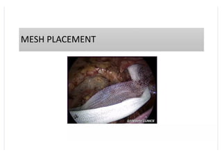 laparoscopic inguinal hernia repair and surgery | PPTX