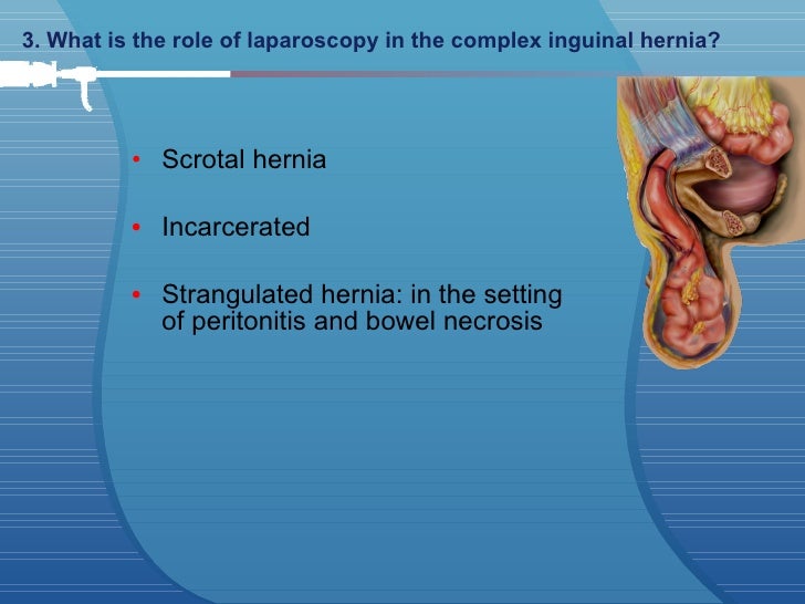Laparoscopic Inguinal Hernia Repair Eminence Based Or Evidence Based