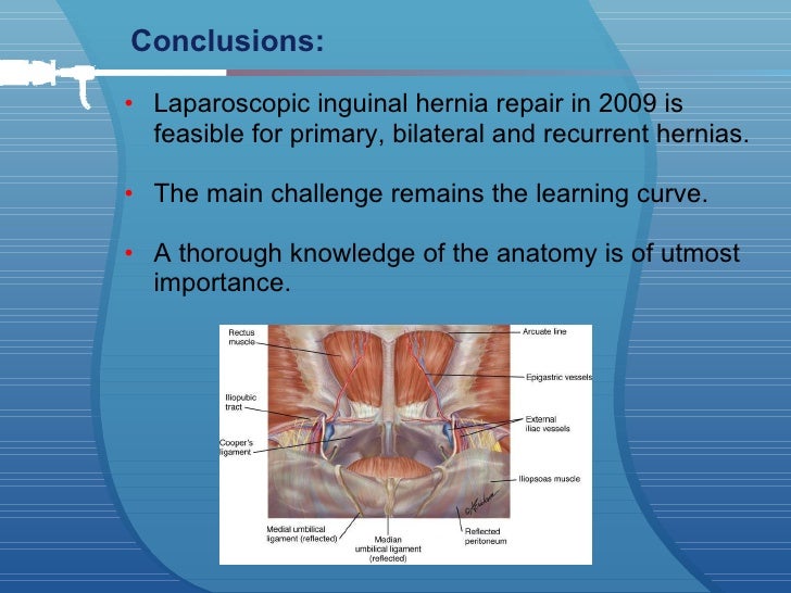 Laparoscopic Inguinal Hernia Repair Eminence-based or Evidence-based?