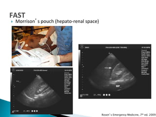 Laparoscopic in Trauma.pdf