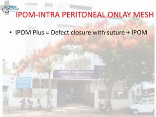 Laparoscopic ipom plus | PPTX