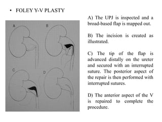 Laparoscopic kidney surg | PPTX