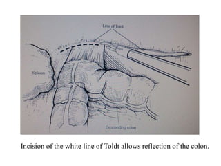 Laparoscopic kidney surg | PPT