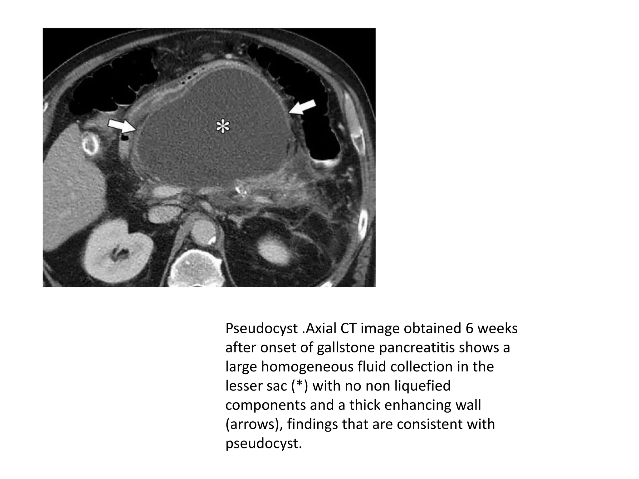 Laparoscopic Management Of Pseudocyst Pancreas.pptx