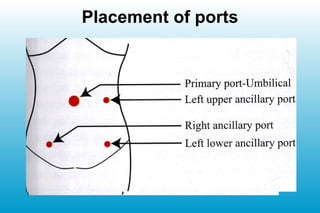 Laparoscopic Myomectomy Mob :7289915430 | PPT
