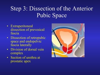 Laparoscopic Prostatectomy Intra- and Extraperitoneal Techniques | PPT