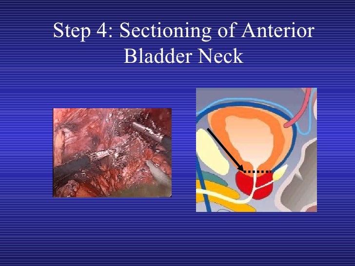 Laparoscopic Prostatectomy Intra- and Extraperitoneal Techniques