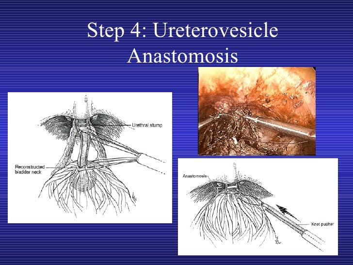 Laparoscopic Prostatectomy Intra- and Extraperitoneal Techniques