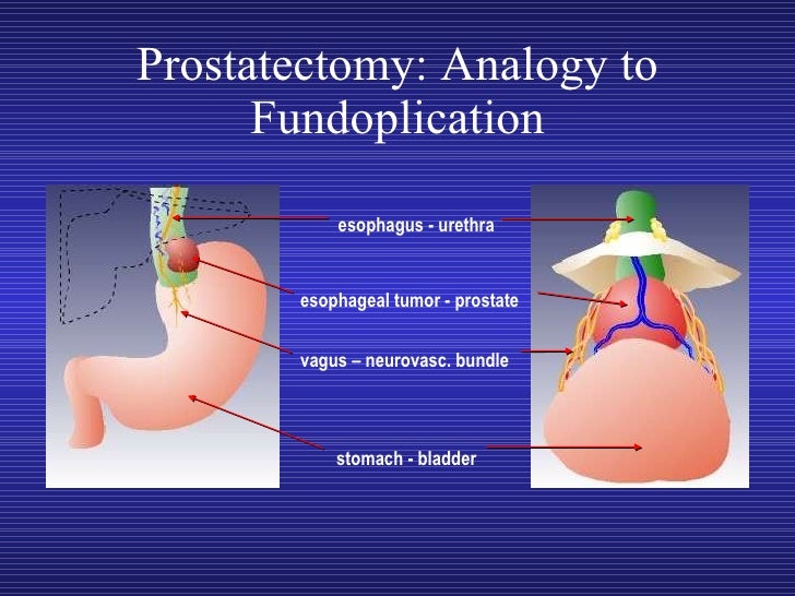 Laparoscopic Prostatectomy Intra- and Extraperitoneal Techniques