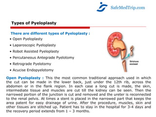 Highly Advanced Laparoscopic Pyeloplasty at World Class Hospitals in ...