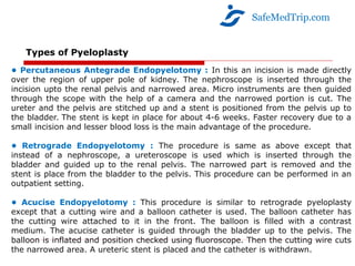 Highly Advanced Laparoscopic Pyeloplasty at World Class Hospitals in ...