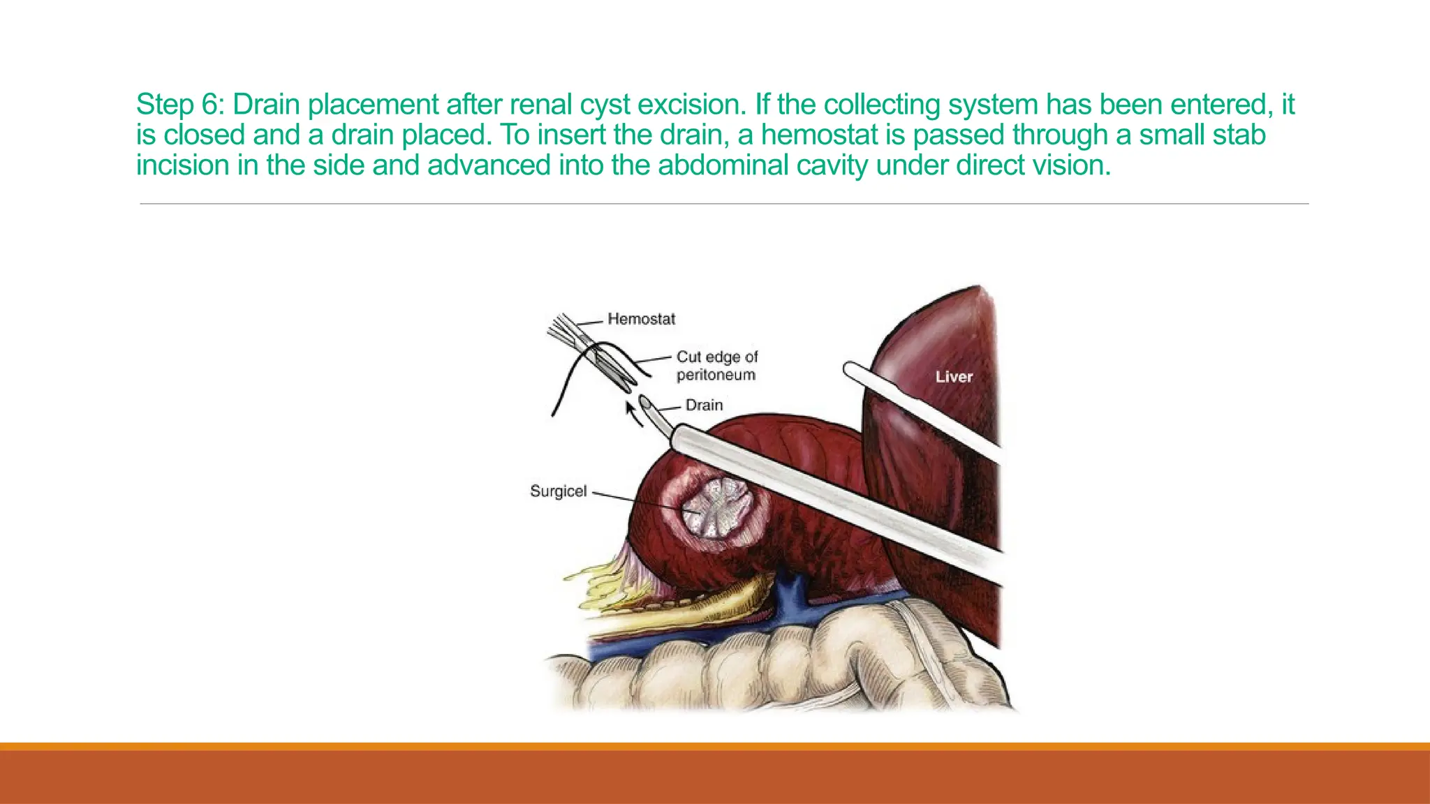 Laparoscopic Renal Cyst Deroofing for renal clear cyst | PPTX
