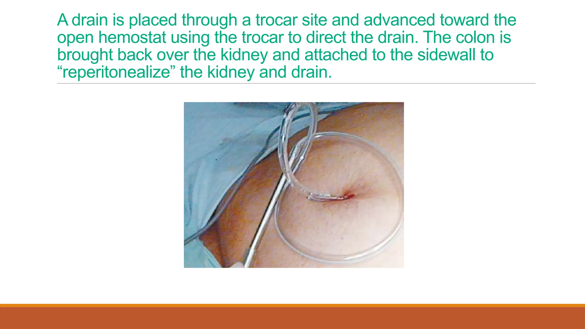 Laparoscopic Renal Cyst Deroofing for renal clear cyst | PPTX