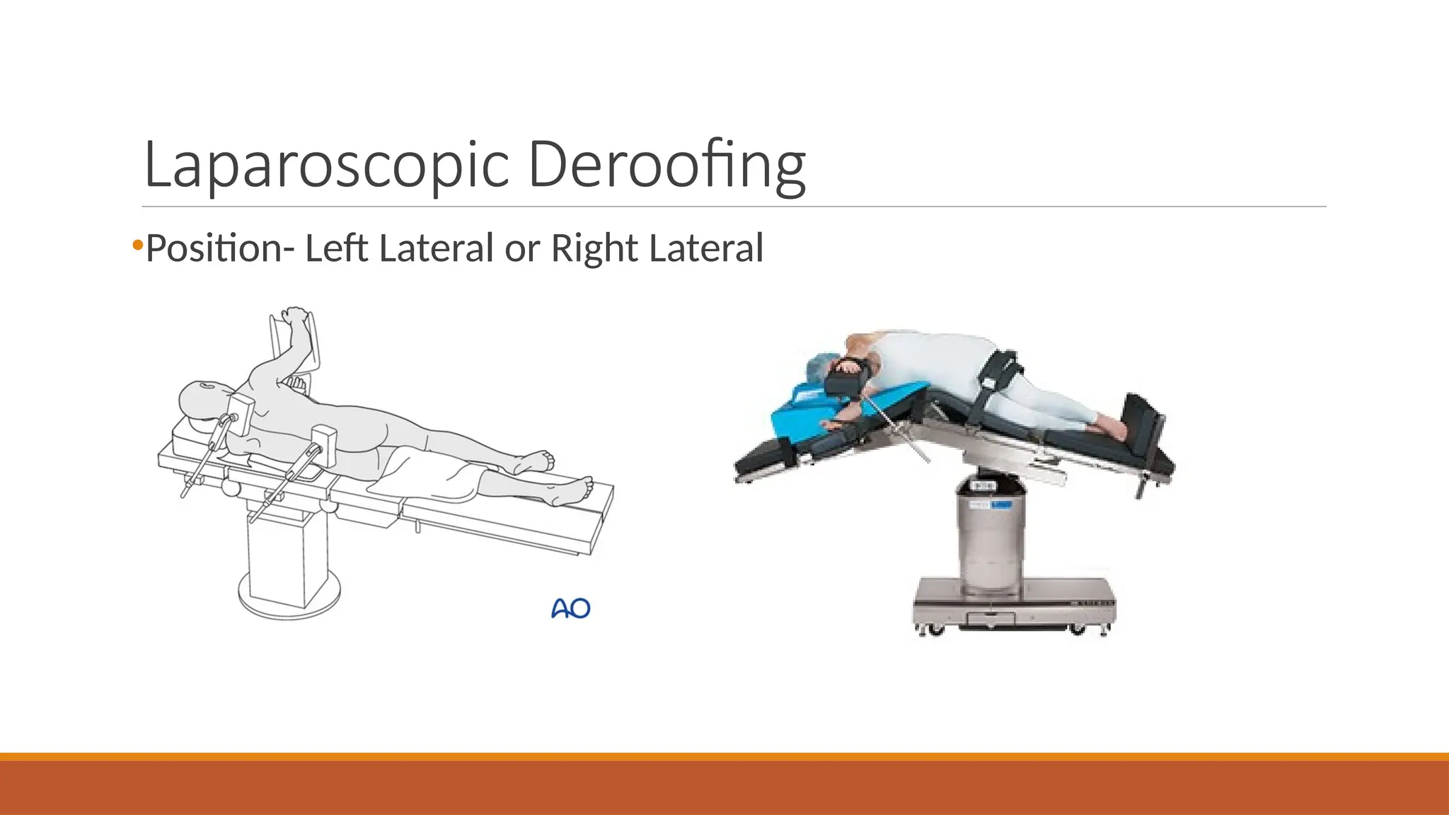 Laparoscopic Renal Cyst Deroofing for renal clear cyst | PPTX