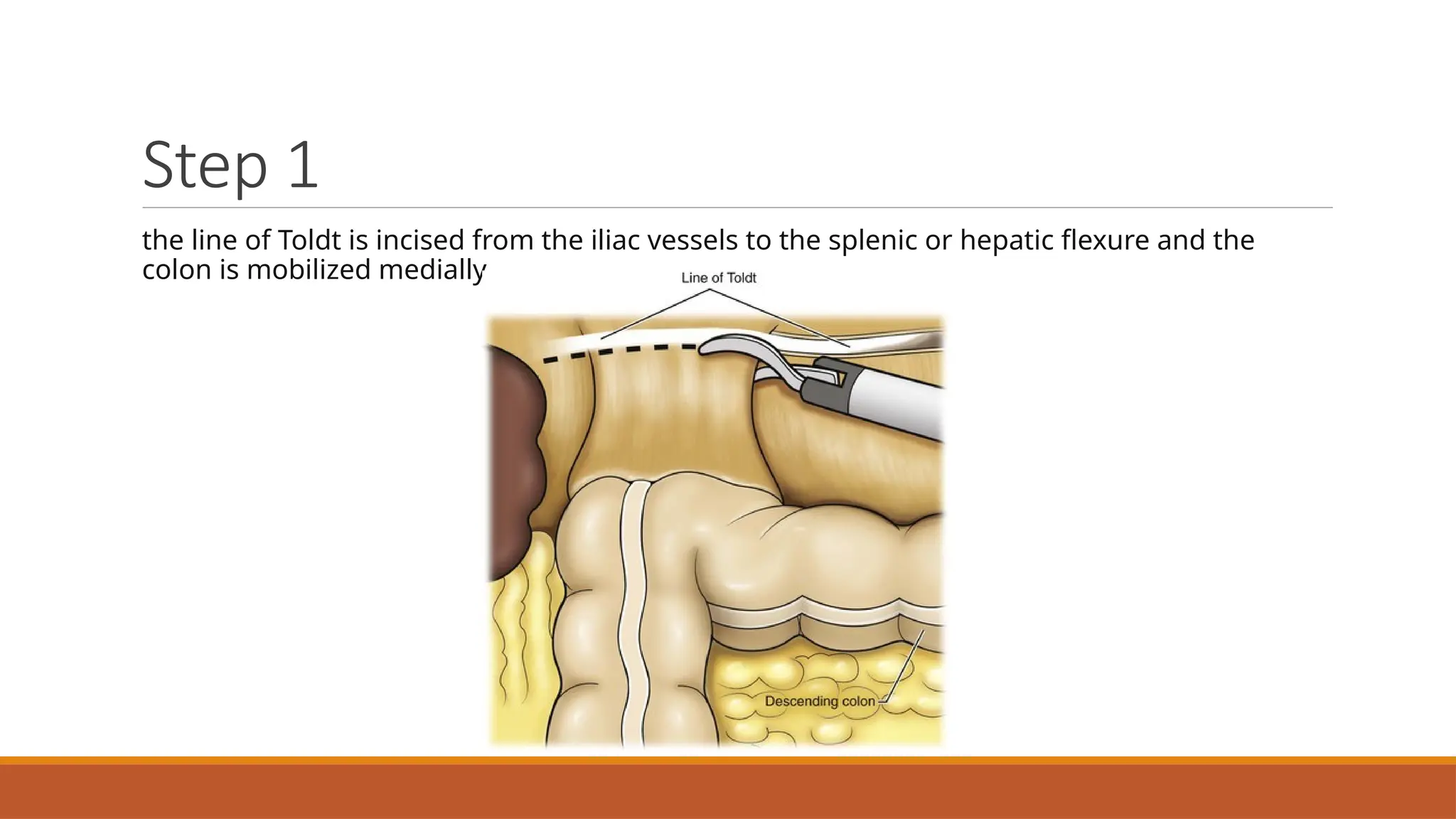 Laparoscopic Renal Cyst Deroofing for renal clear cyst | PPTX