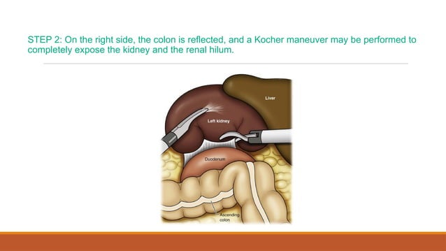 Laparoscopic Renal Cyst Deroofing for renal clear cyst | PPTX | Surgery ...