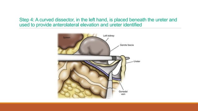 Laparoscopic Renal Cyst Deroofing for renal clear cyst | PPTX | Surgery ...