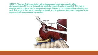 Laparoscopic Renal Cyst Deroofing for renal clear cyst | PPTX