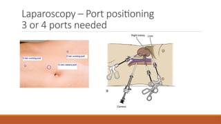 Laparoscopic Renal Cyst Deroofing for renal clear cyst | PPTX | Surgery | Medical Health