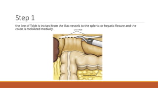 Laparoscopic Renal Cyst Deroofing for renal clear cyst | PPTX | Surgery ...